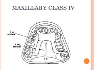 Design of removable partial denture | PPT