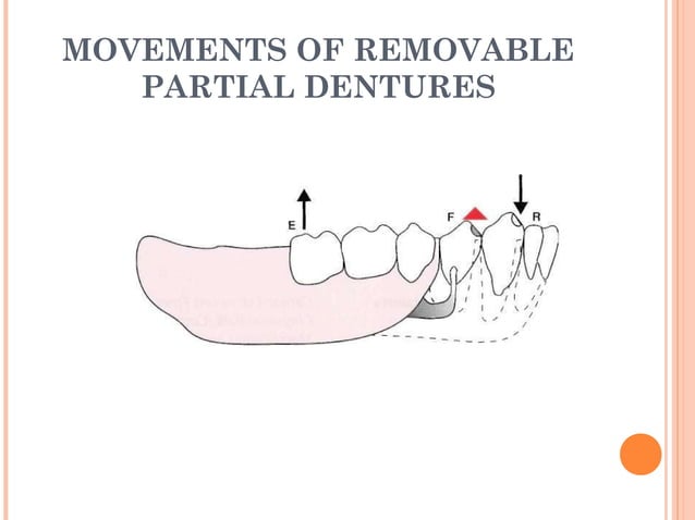 Design of removable partial denture | PPT | Dental Health | Diseases ...