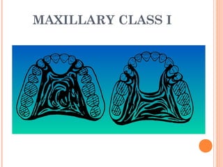 Design of removable partial denture | PPT