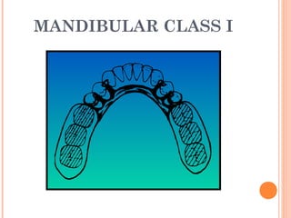 Design of removable partial denture | PPT