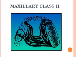 Design of removable partial denture | PPT