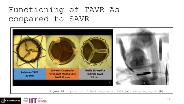 DESIGN OF TRANS-CATHETER AORTIC VALVE REPLACEMENT (TAVR).pptx