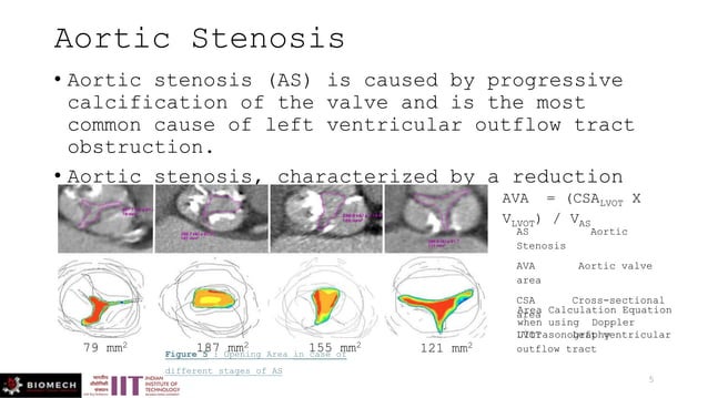 DESIGN OF TRANS-CATHETER AORTIC VALVE REPLACEMENT (TAVR).pptx