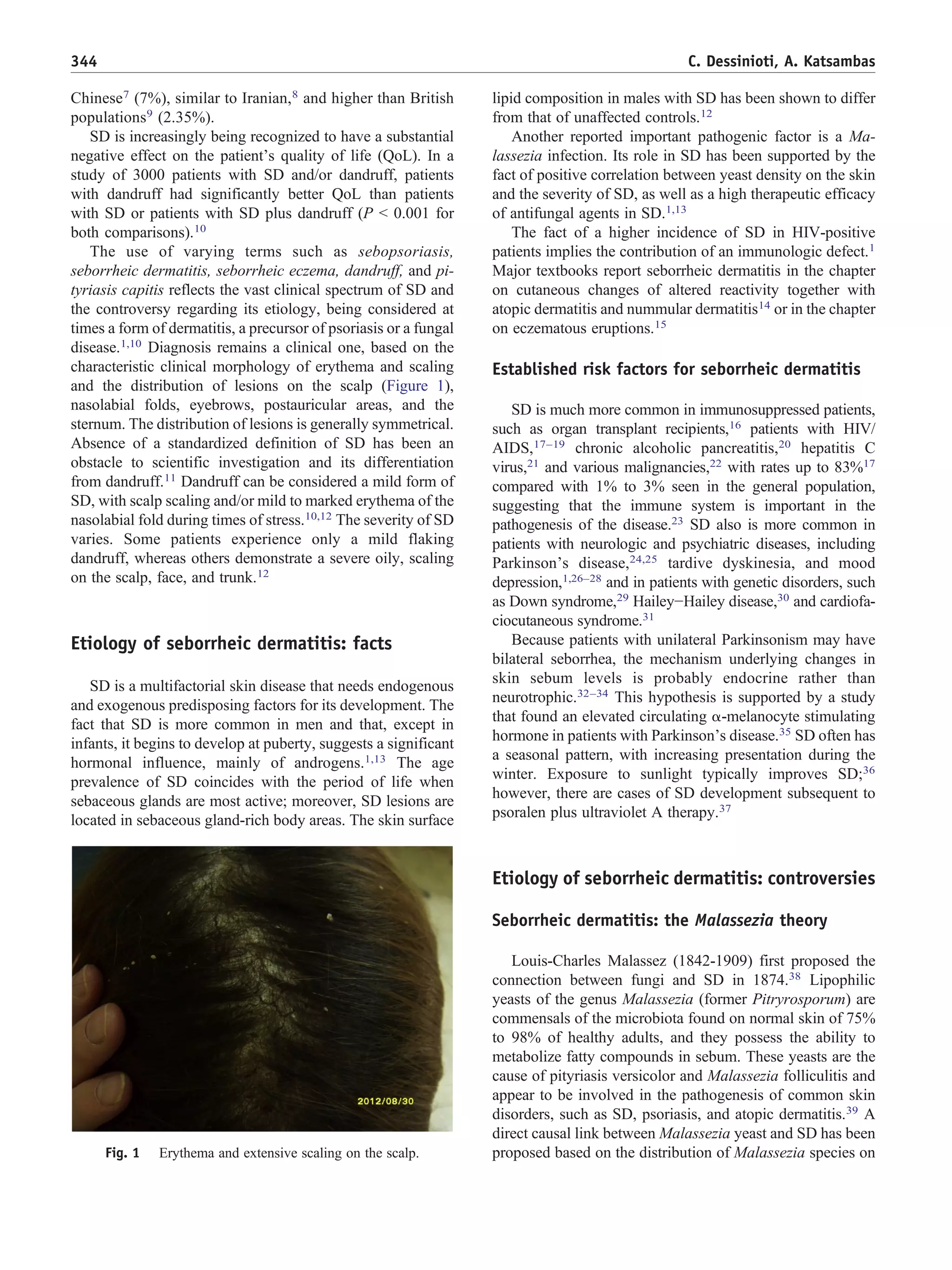 Seborrheic Dermatitis - Risk factors and Treatment | PDF