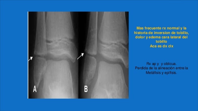 Deslizamiento epifisiario Salter Harris