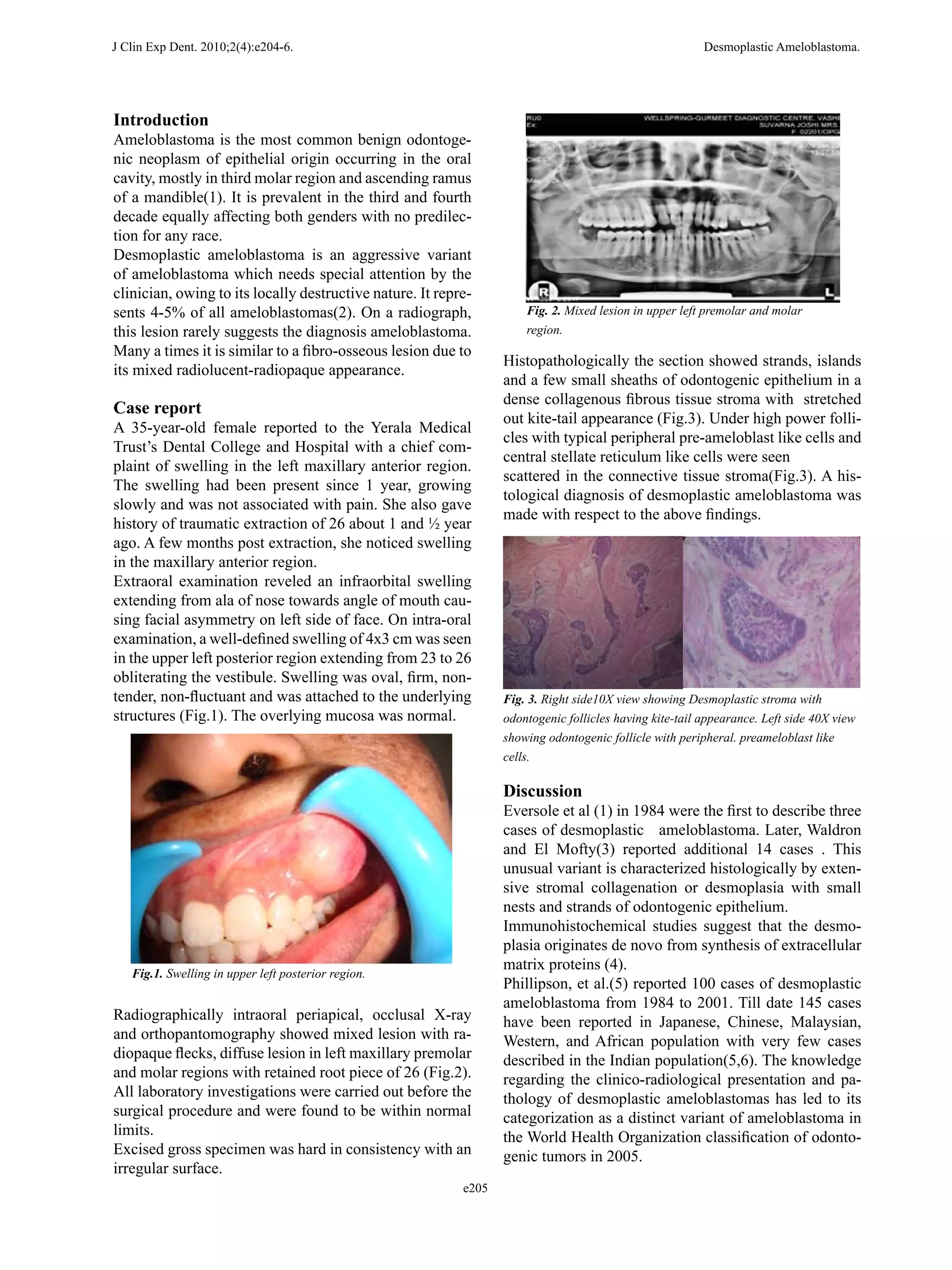 Desmoplastic ameloblastoma of maxilla a case report | PDF
