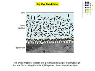 Dry eye disease or syndrome AAO NOOB.pptx