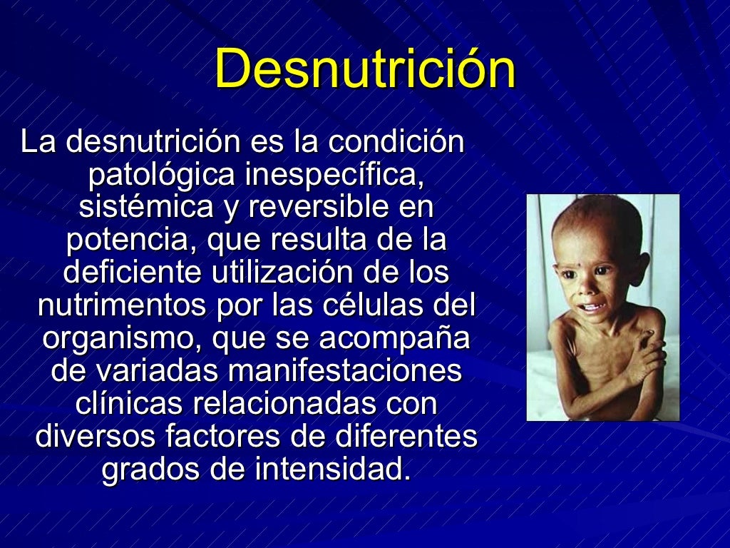 Desnutricion