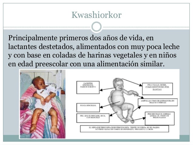 Desnutrición Marasmo / Kwashiorkor