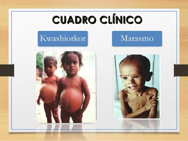 Desnutricion Infantil