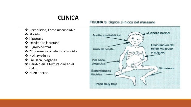 Desnutricion,marasmo, kwashiorkor