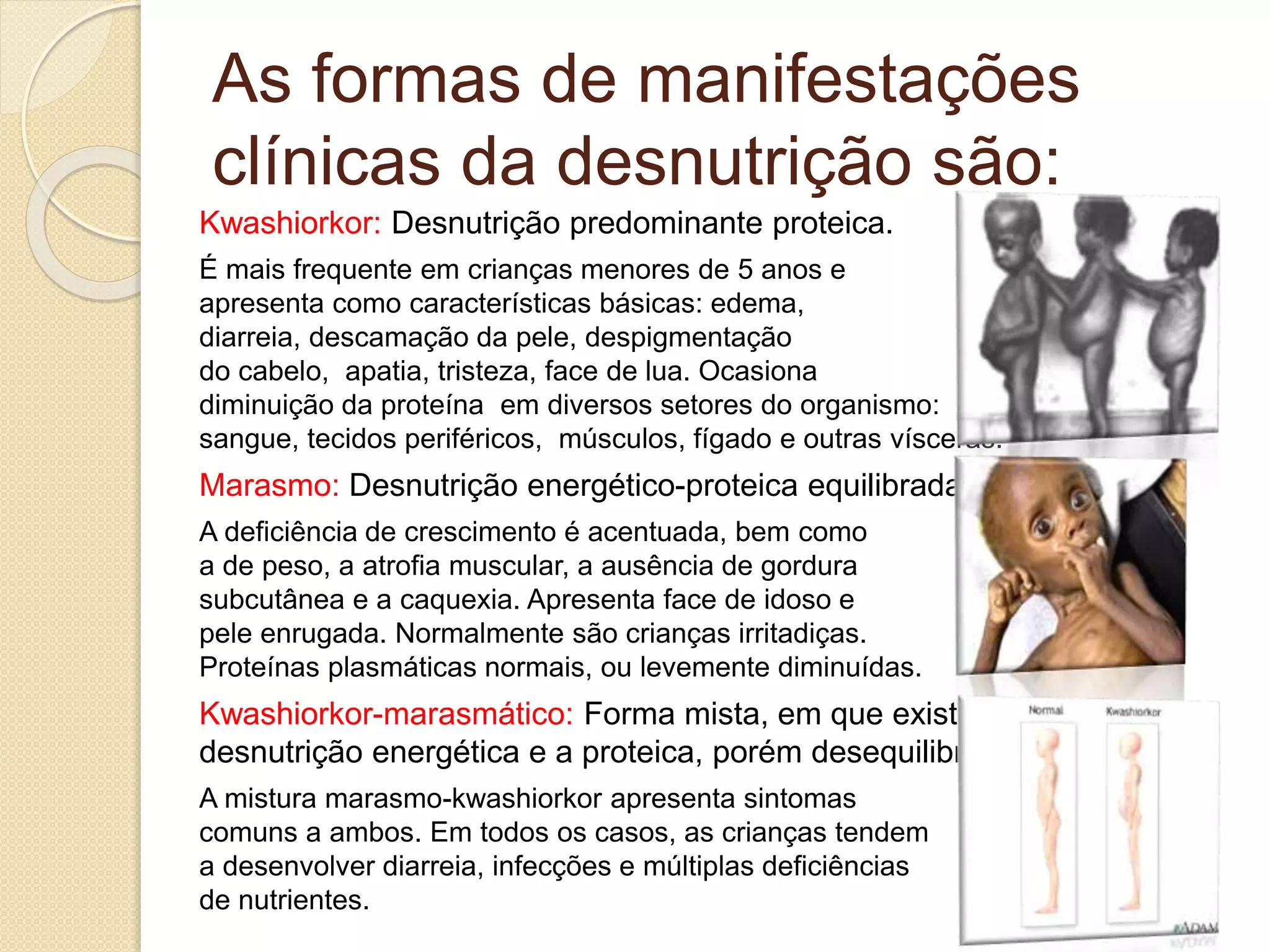 Desnutrição Infantil | PPT