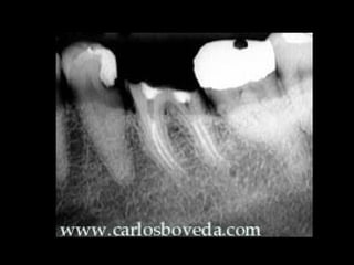 Desobturacion del Conducto Radicular | PPT