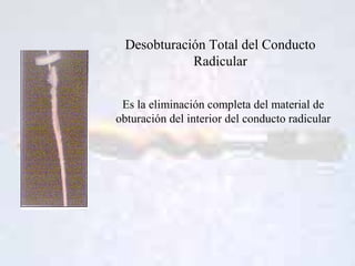 Desobturacion del Conducto Radicular | PPT