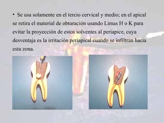 Desobturacion del Conducto Radicular | PPT