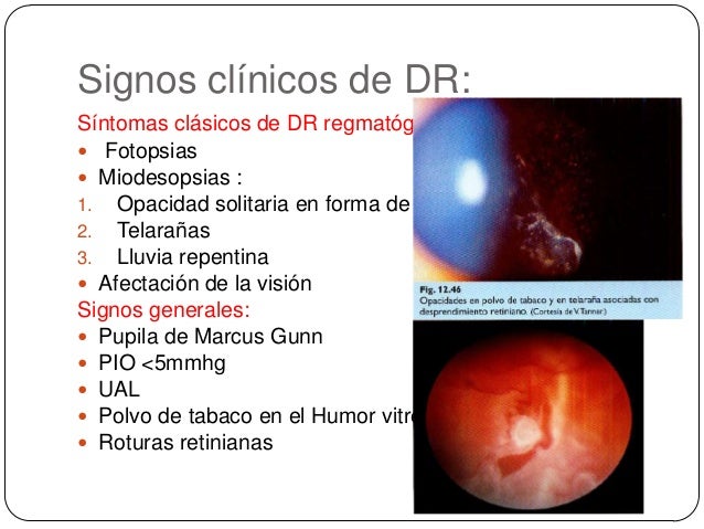 Desprendimiento De Retina