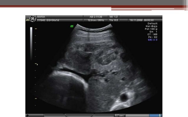 Desprendimiento prematuro de placenta normoinserta (dppni)