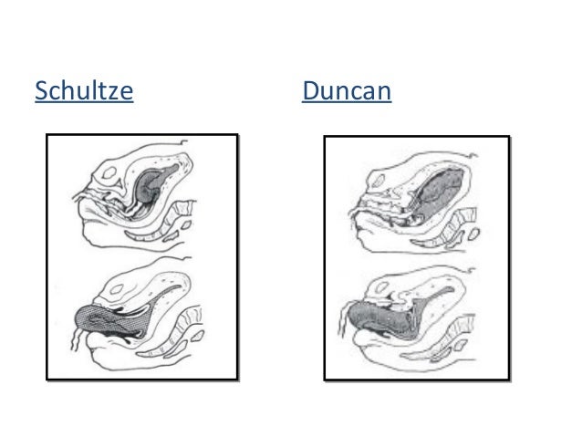 Desprendimiento y expulsion de la placenta