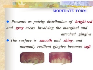 DESQUAMATIVE GINGIVITIS.ppt