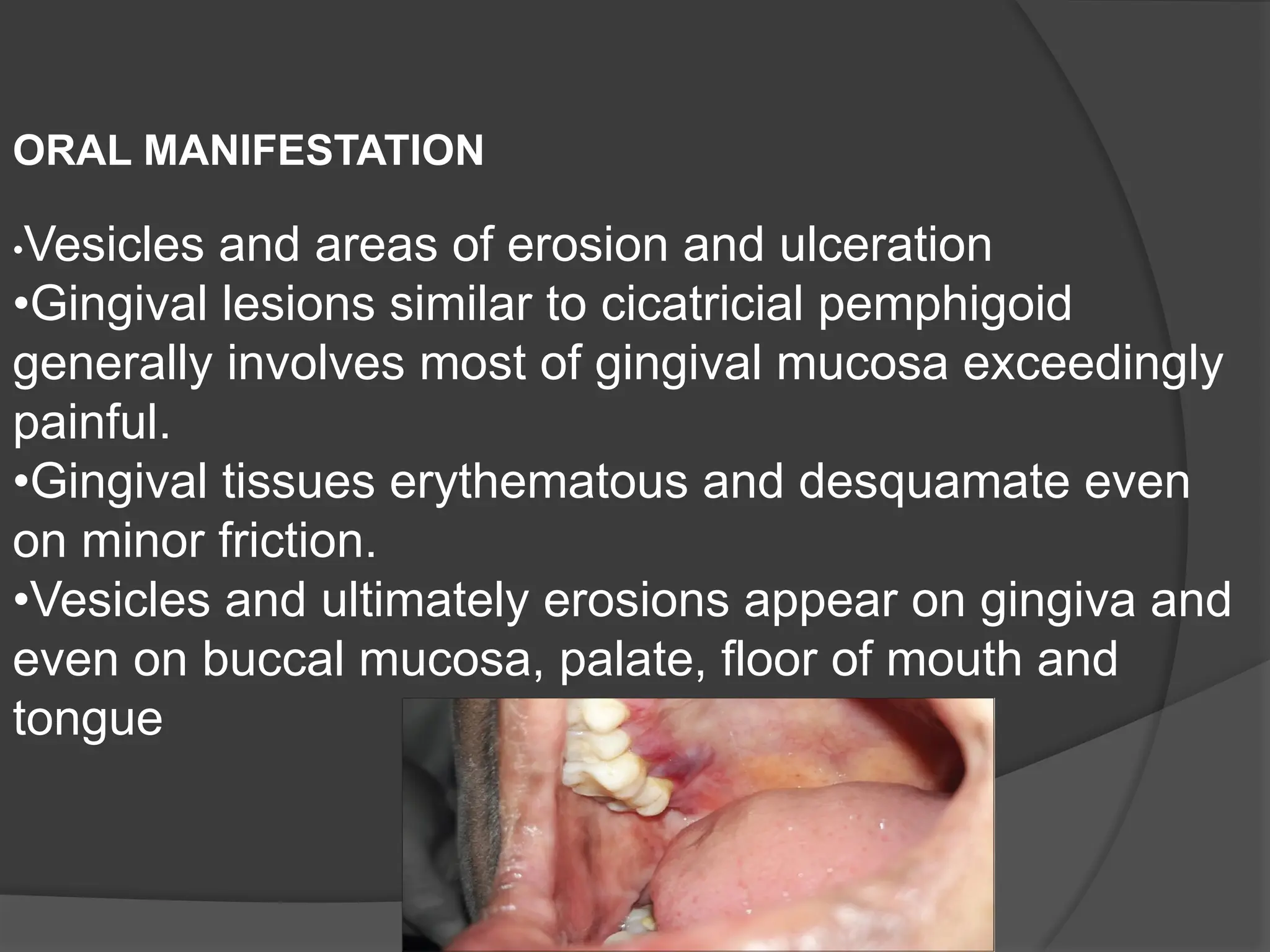 Desquamative gingivitis- lesions on the gingiva | PPTX
