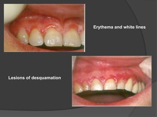 Desquamative gingivitis- lesions on the gingiva | PPTX