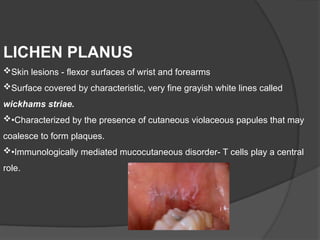 Desquamative gingivitis- lesions on the gingiva | PPTX