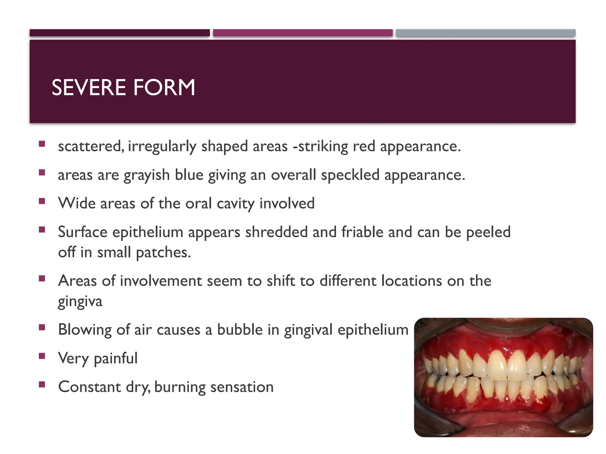 Desquamative gingivitis types and management | PPTX