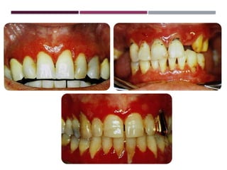 Desquamative gingivitis types and management | PPTX