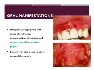 Desquamative gingivitis types and management | PPTX
