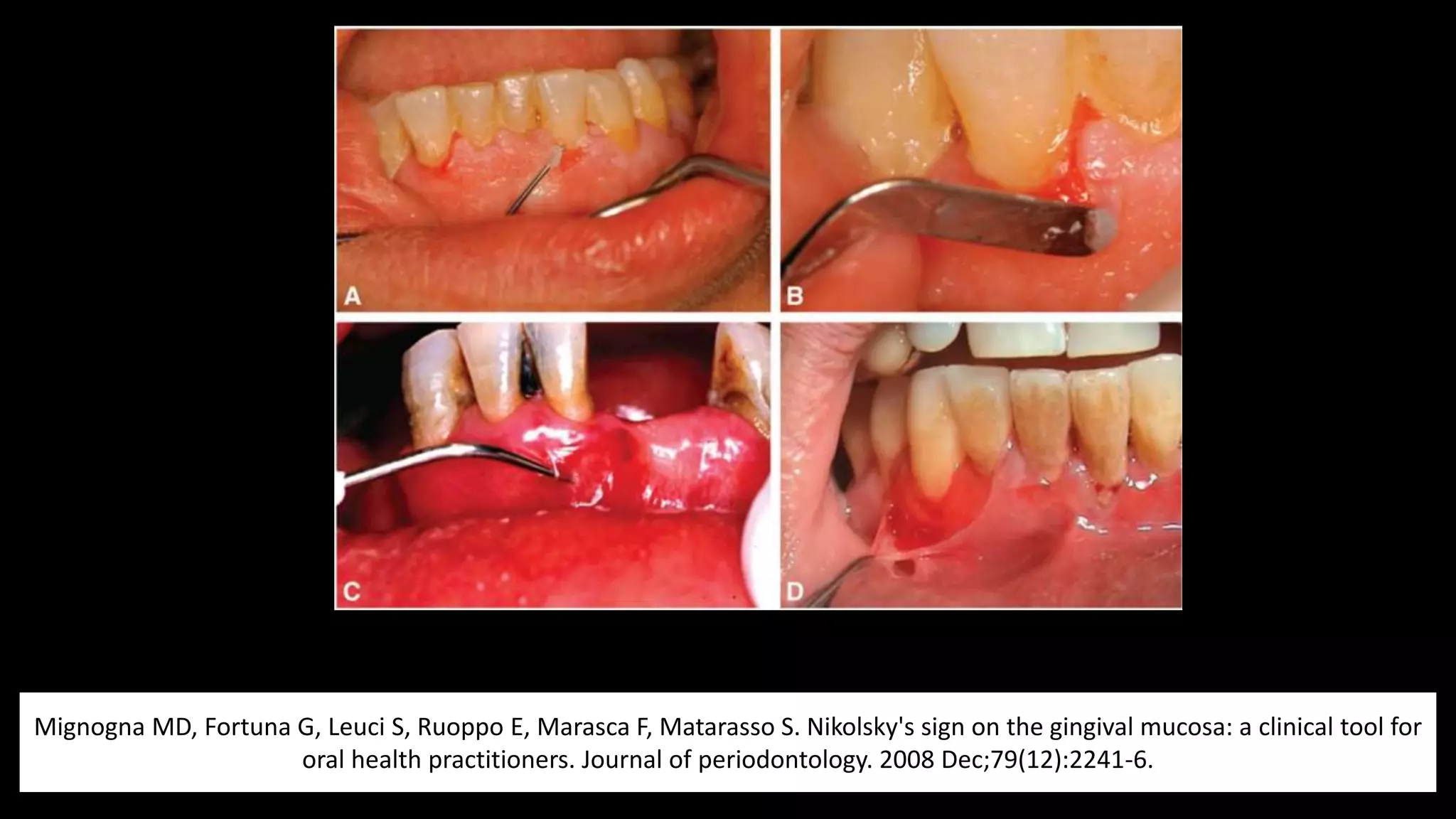 Desquamative gingivitis ppt | PPTX
