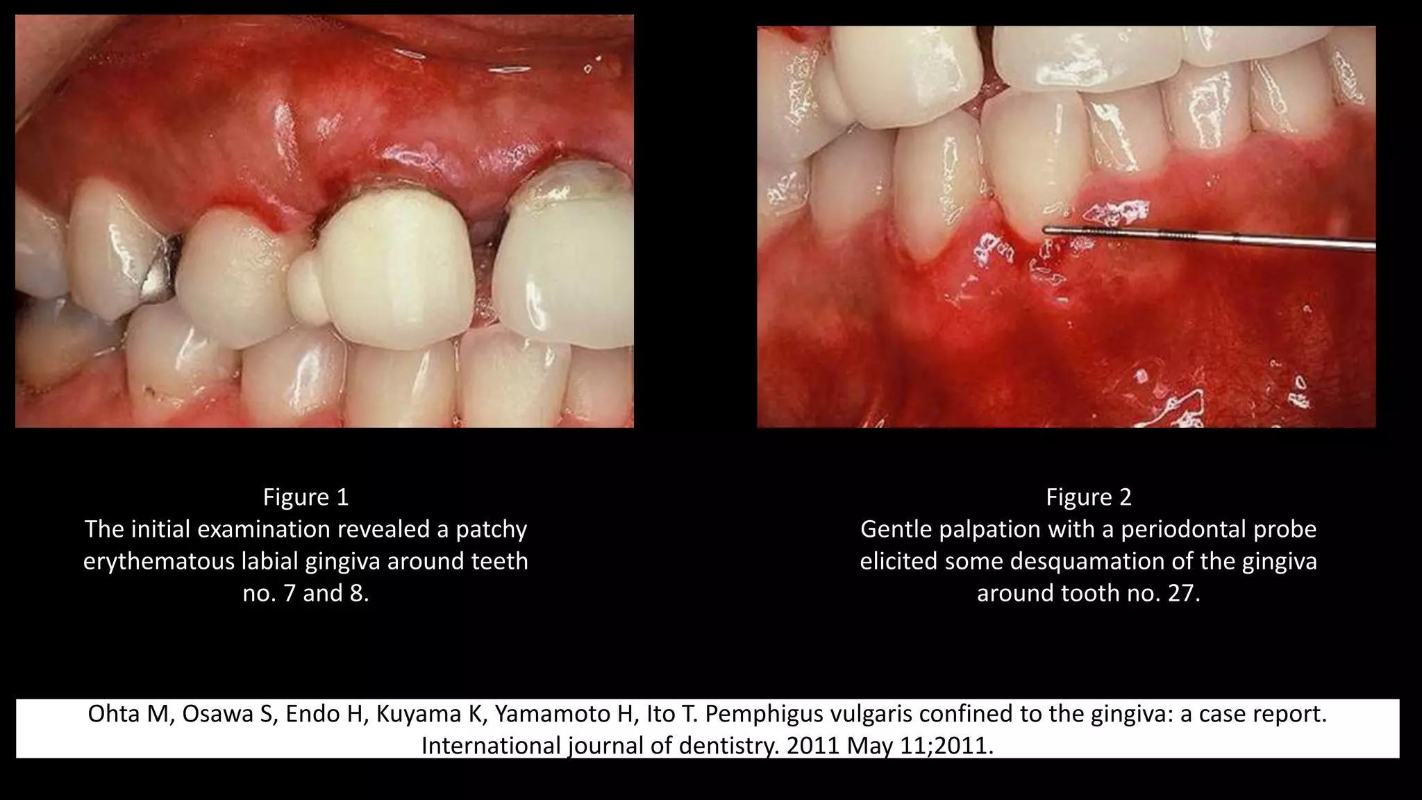 Desquamative gingivitis ppt | PPTX