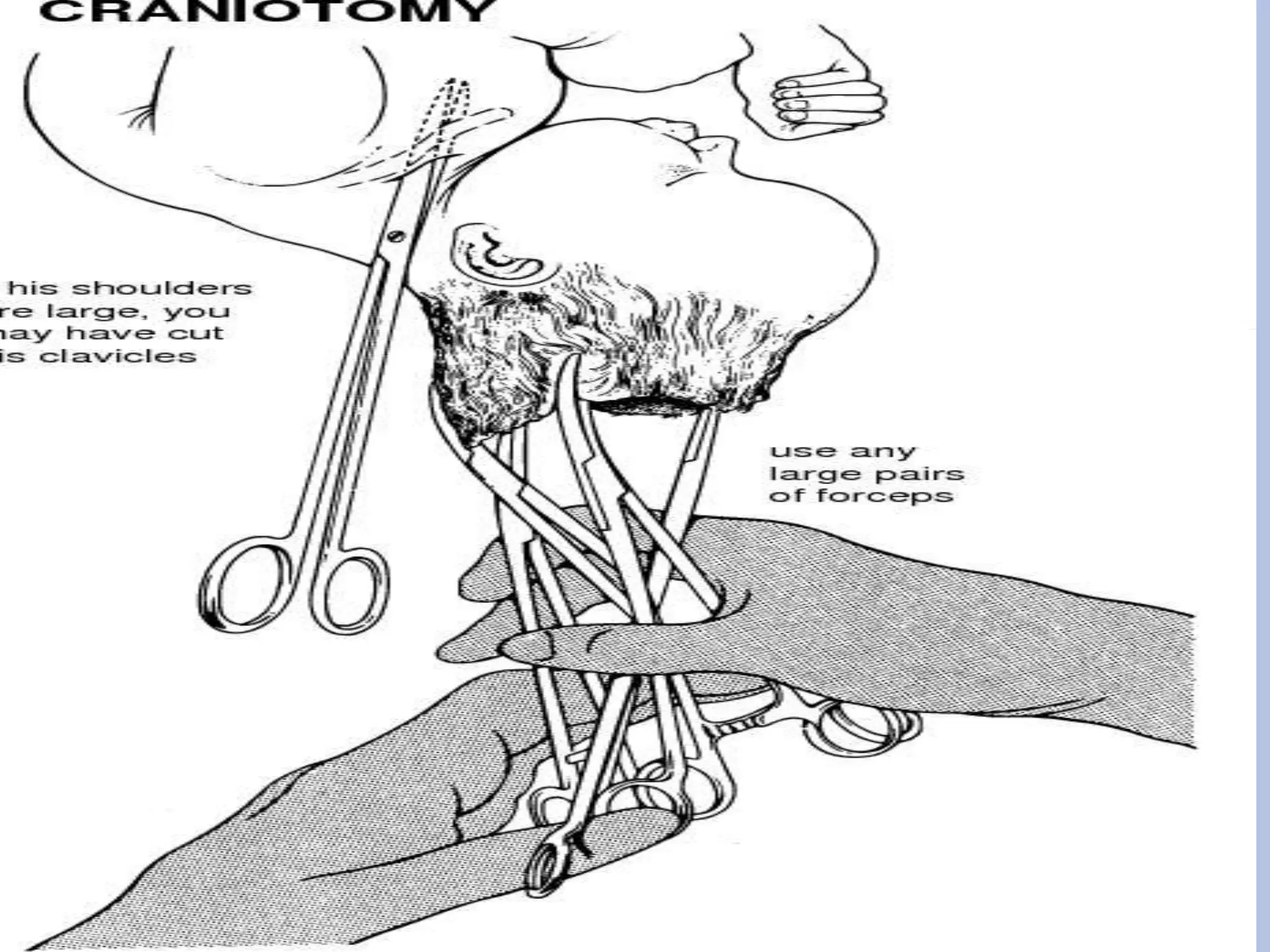 Destructive operation | PPTX