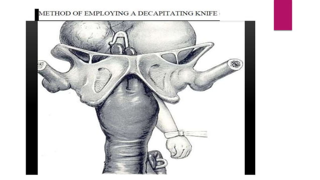 Destructive operations | PPTX | Pregnancy | Reproductive Health