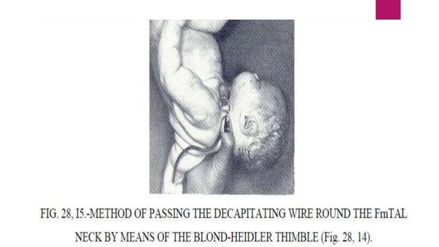 Destructive operations | PPTX | Pregnancy | Reproductive Health