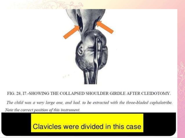 destructive operations.pptx | Free Download