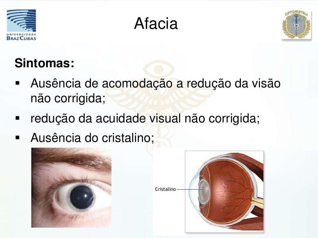 Desvio ocular,diplopia afacia dismetria