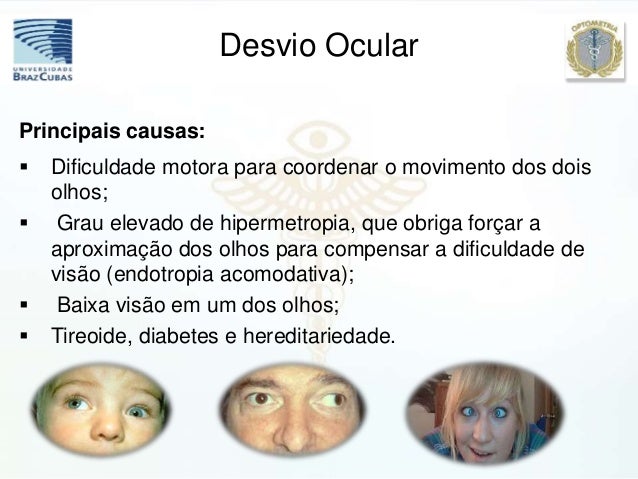 Desvio ocular,diplopia afacia dismetria