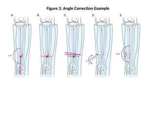 Detailed_Cast_Wedging_Presentation 2.pptx