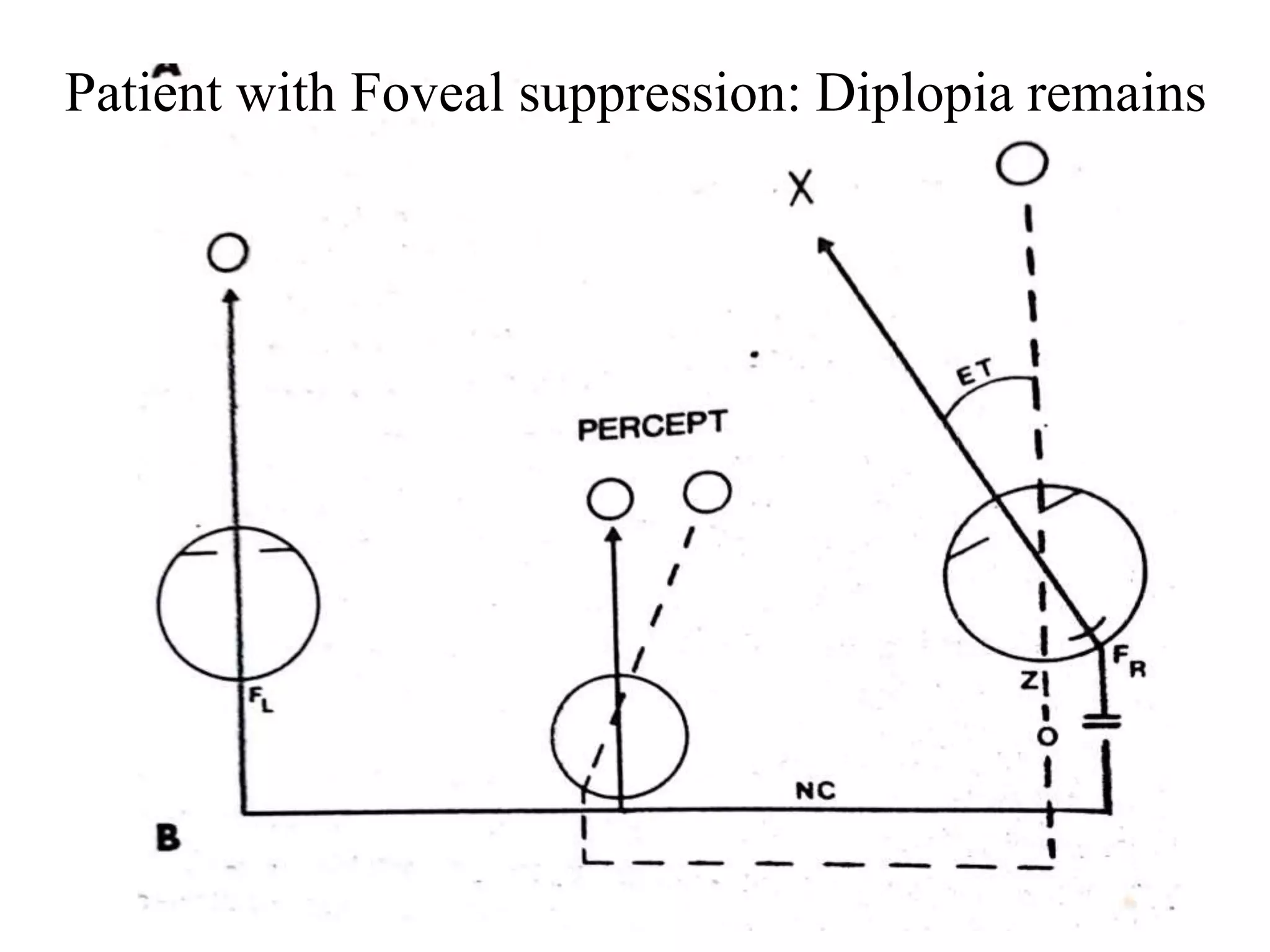 Detail of suppression and AC | PPTX