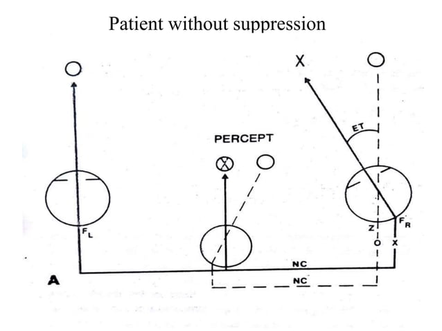 Detail of suppression and AC | PPTX | Eye and Vision Conditions ...