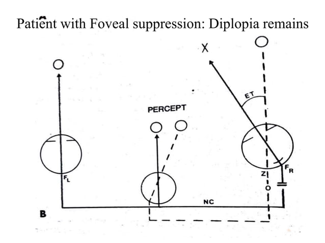 Detail of suppression and AC | PPTX | Eye and Vision Conditions ...