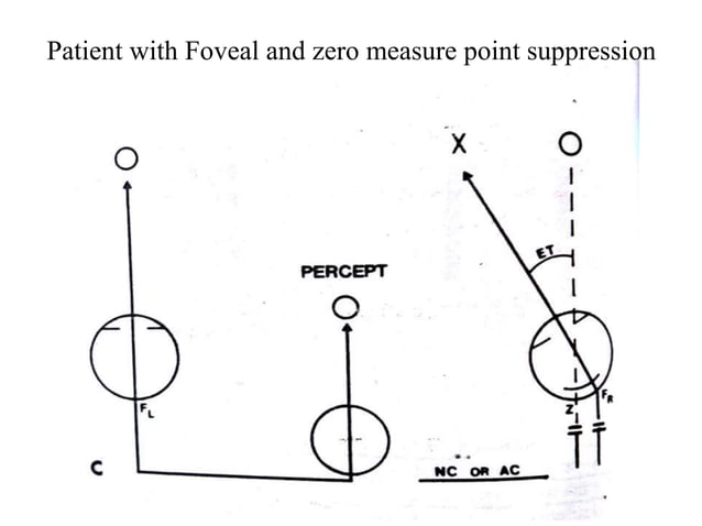 Detail of suppression and AC | PPTX | Eye and Vision Conditions ...