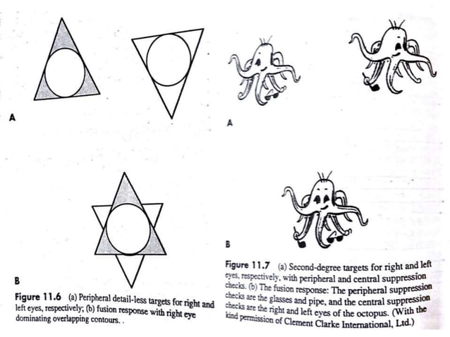 Detail of suppression and AC | PPTX | Eye and Vision Conditions ...