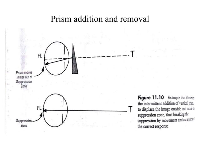 Detail of suppression and AC | PPTX | Eye and Vision Conditions ...