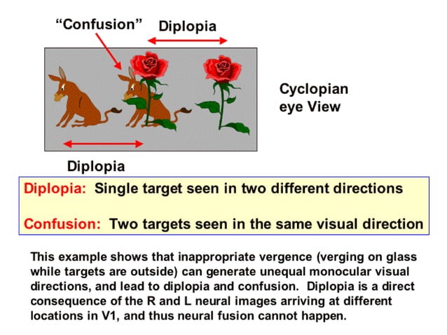 Detail of suppression and AC | PPTX | Eye and Vision Conditions ...
