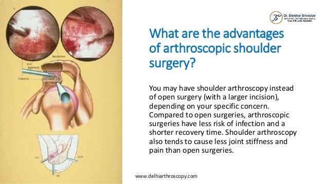 Details About Shoulder Arthroscopy | PDF