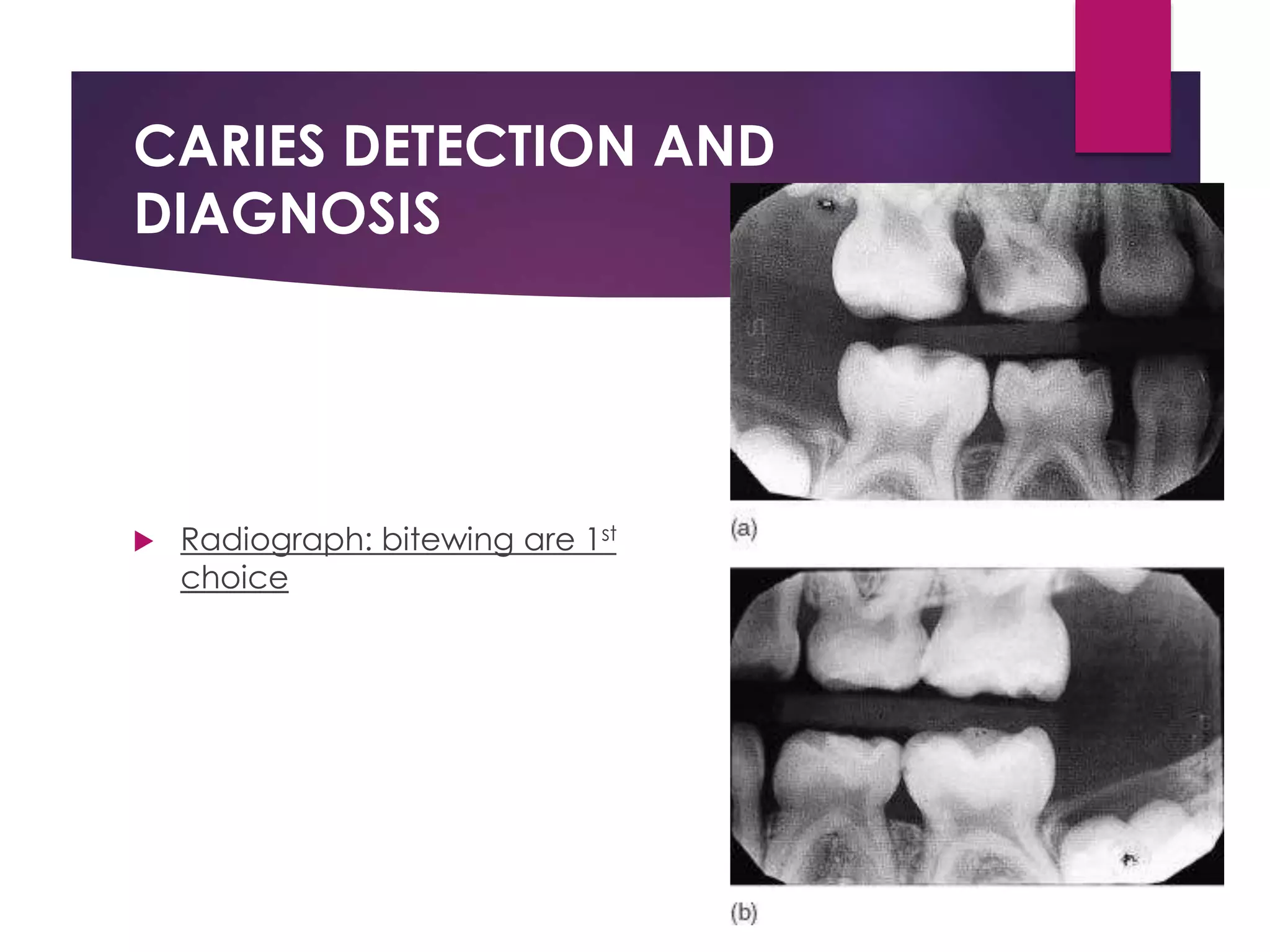 Detection, diagnosis and prevention of dental caries | PPTX