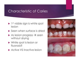 Detection, diagnosis and prevention of dental caries | PPTX