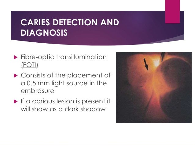 Detection, diagnosis and prevention of dental caries