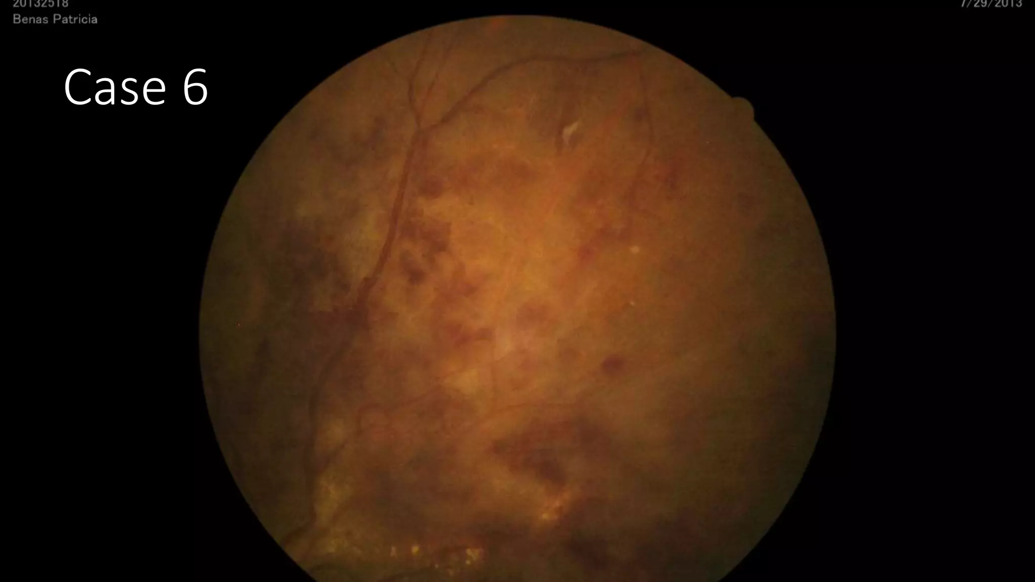 Pre Test Detection Of Diabetic Retinopathy Using Fundus Photos Online Quiz Pptx Eye And